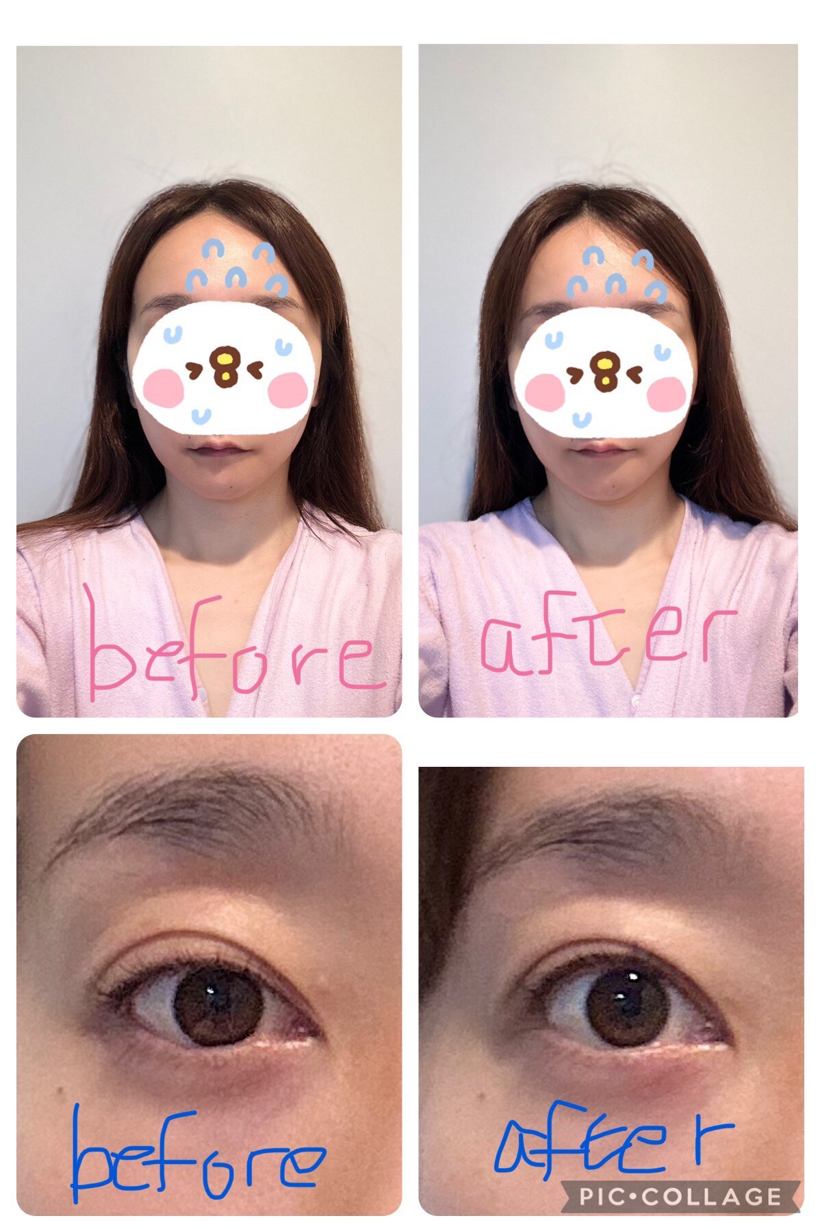 円皮鍼 seirin セイリン パイオネックス・ゼロ pyonex zero - 皮膚に刺入しない接触タイプ!治療後のケアにも活用!